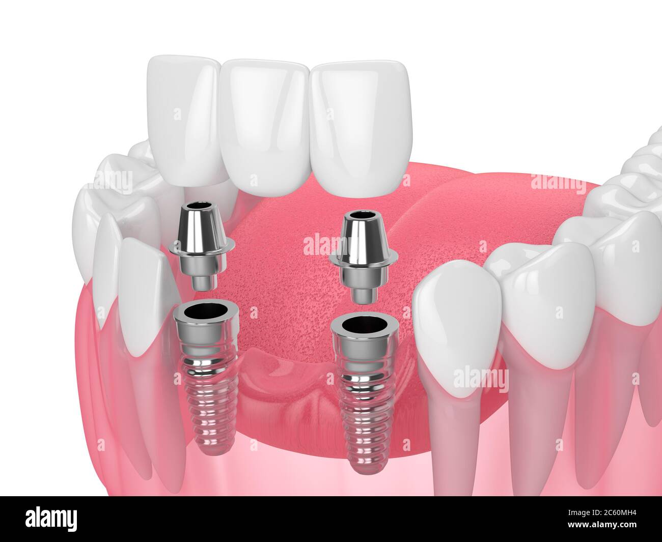 Jaw implants supporting dental bridge hi-res stock photography and ...