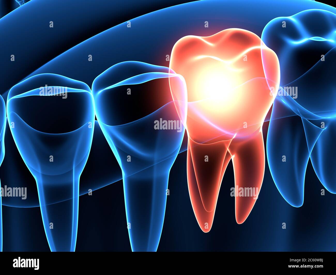 3d render of jaw x-ray with aching molar tooth. Toothache concept Stock ...