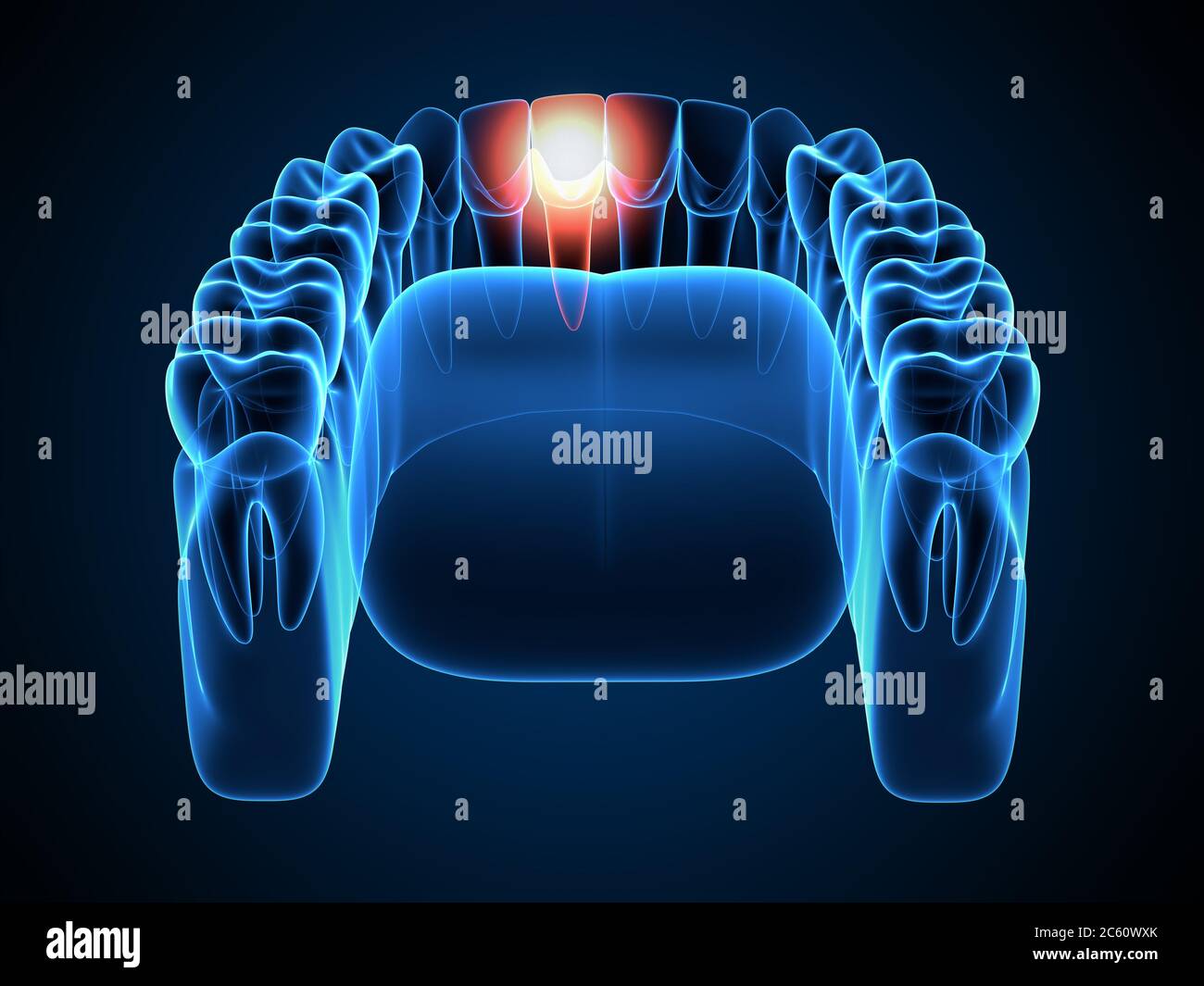 3d render of jaw x-ray with aching molar tooth. Toothache concept Stock ...