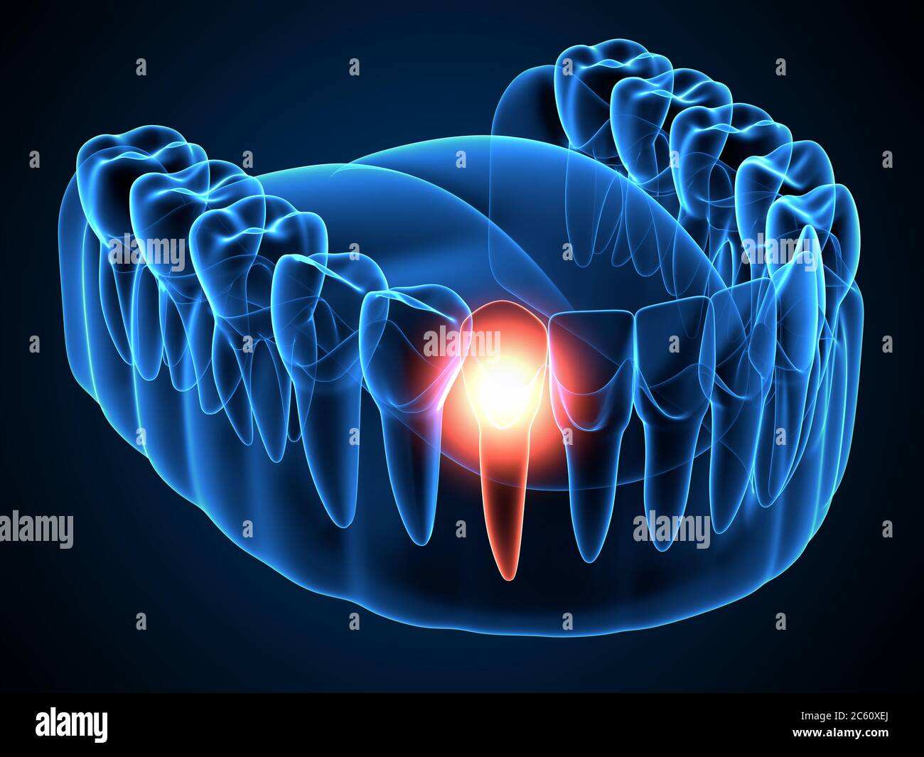 3d render of jaw x-ray with aching molar tooth. Toothache concept Stock ...
