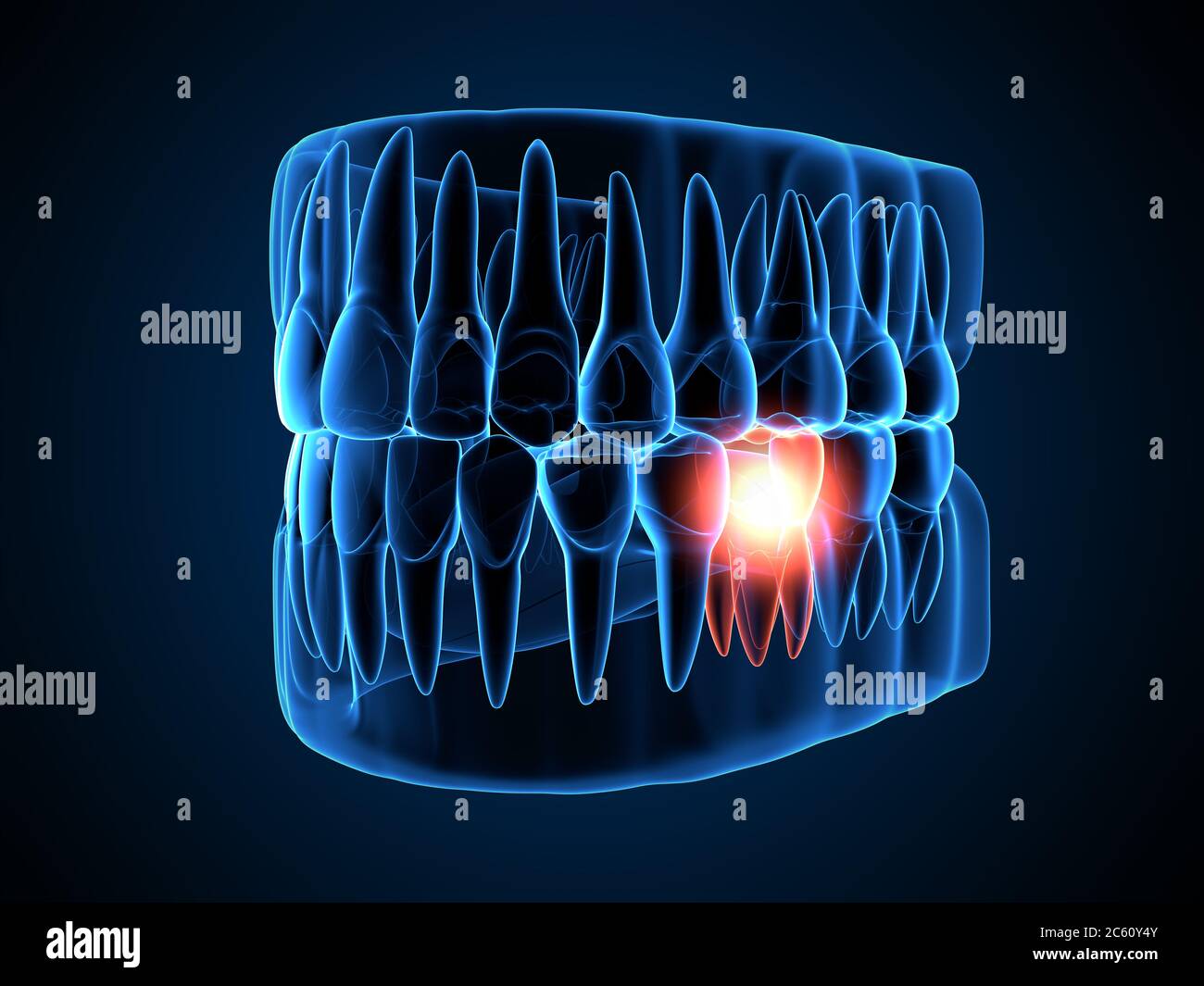 3d render of jaw x-ray with aching molar tooth. Toothache concept Stock ...
