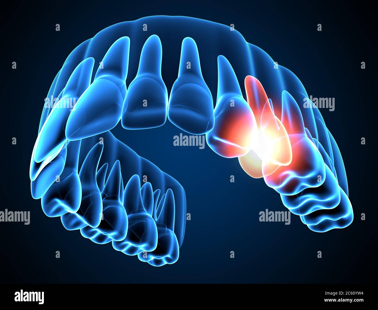 3d render of jaw x-ray with throbbing premolar toothache Stock Photo ...