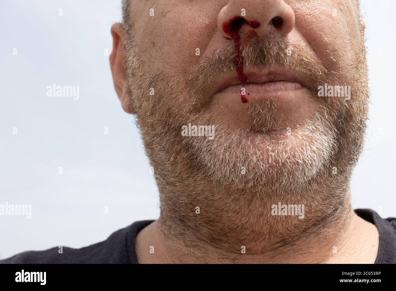 Bleeding nose hi-res stock photography and images - Alamy