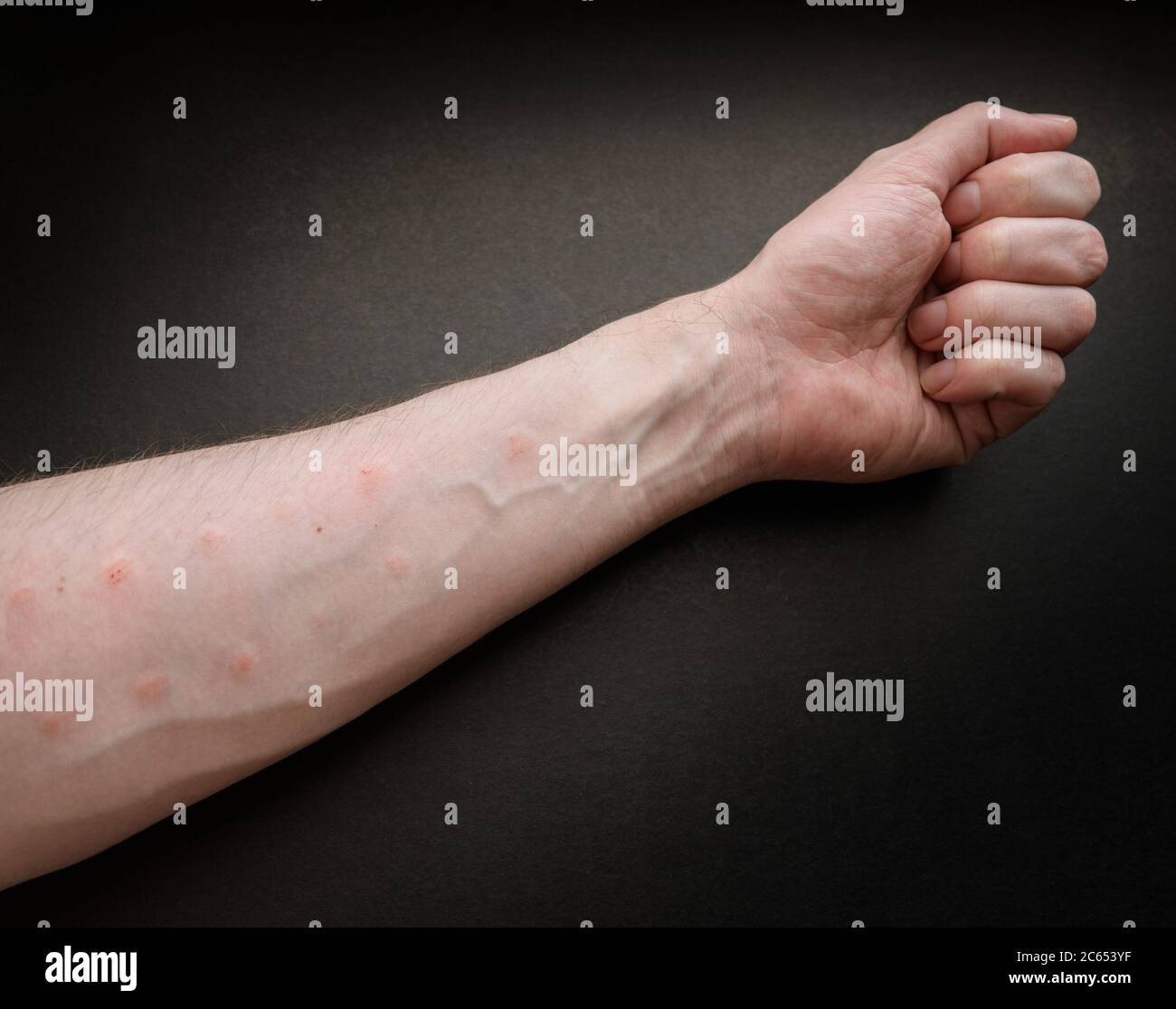 Skin allergy test hi-res stock photography and images - Alamy
