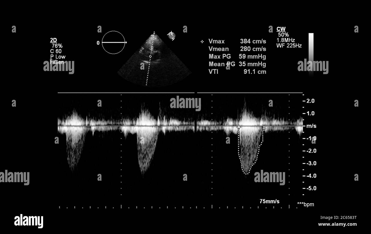 Image of the heart in gray-scale mode during transesophageal ultrasound ...