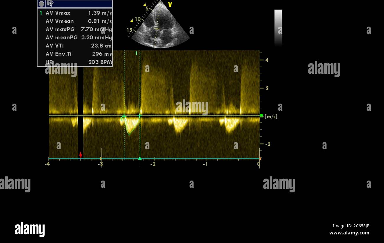 Image of the heart in gray-scale mode during transesophageal ultrasound ...