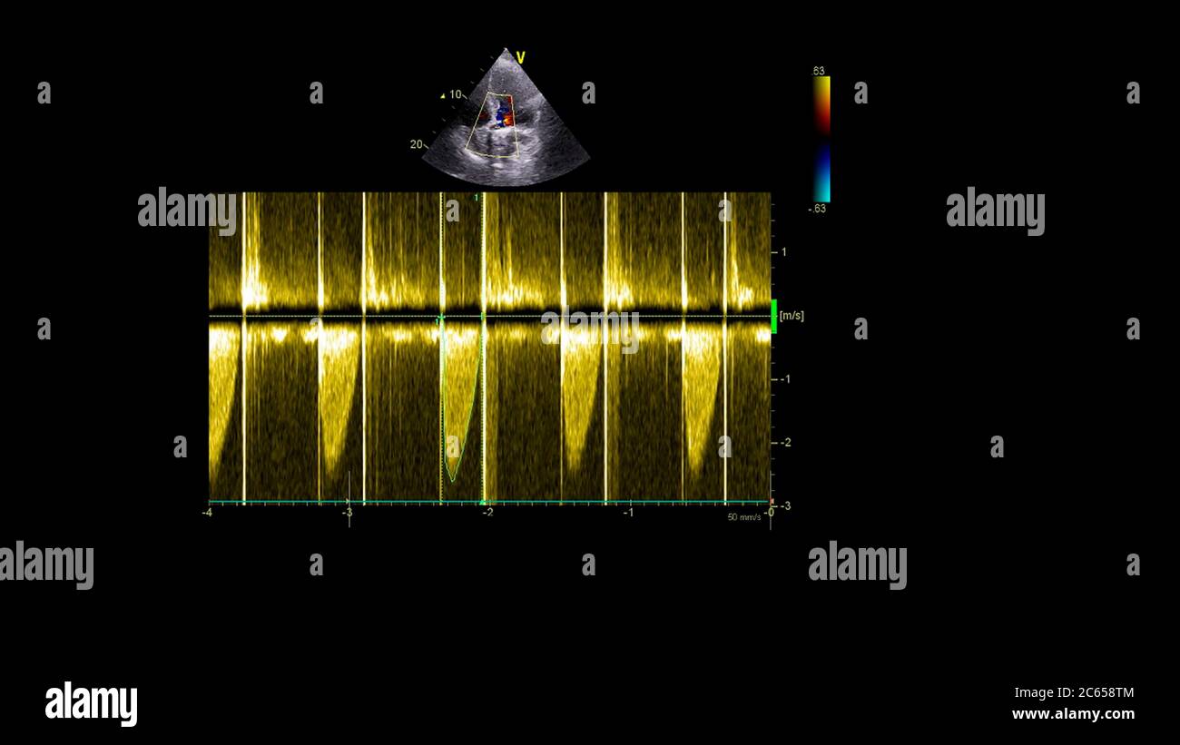 Image of the heart during transesophageal ultrasound with Doppler mode ...