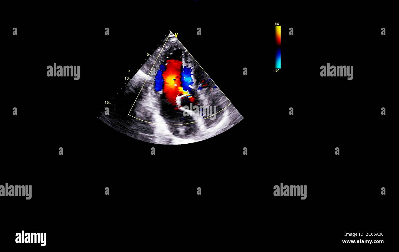 Color doppler ultrasound hi-res stock photography and images - Alamy