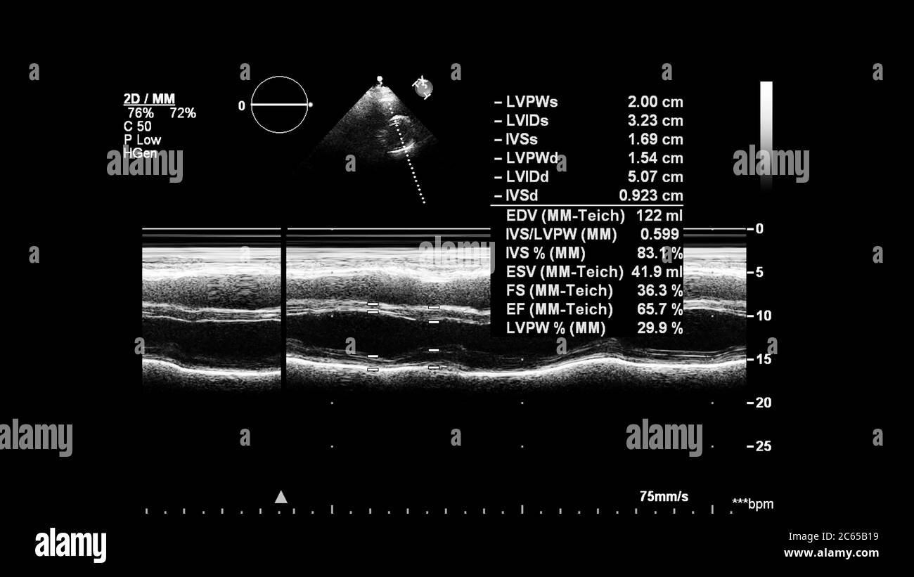 Image of the heart in gray-scale mode during transesophageal ultrasound ...