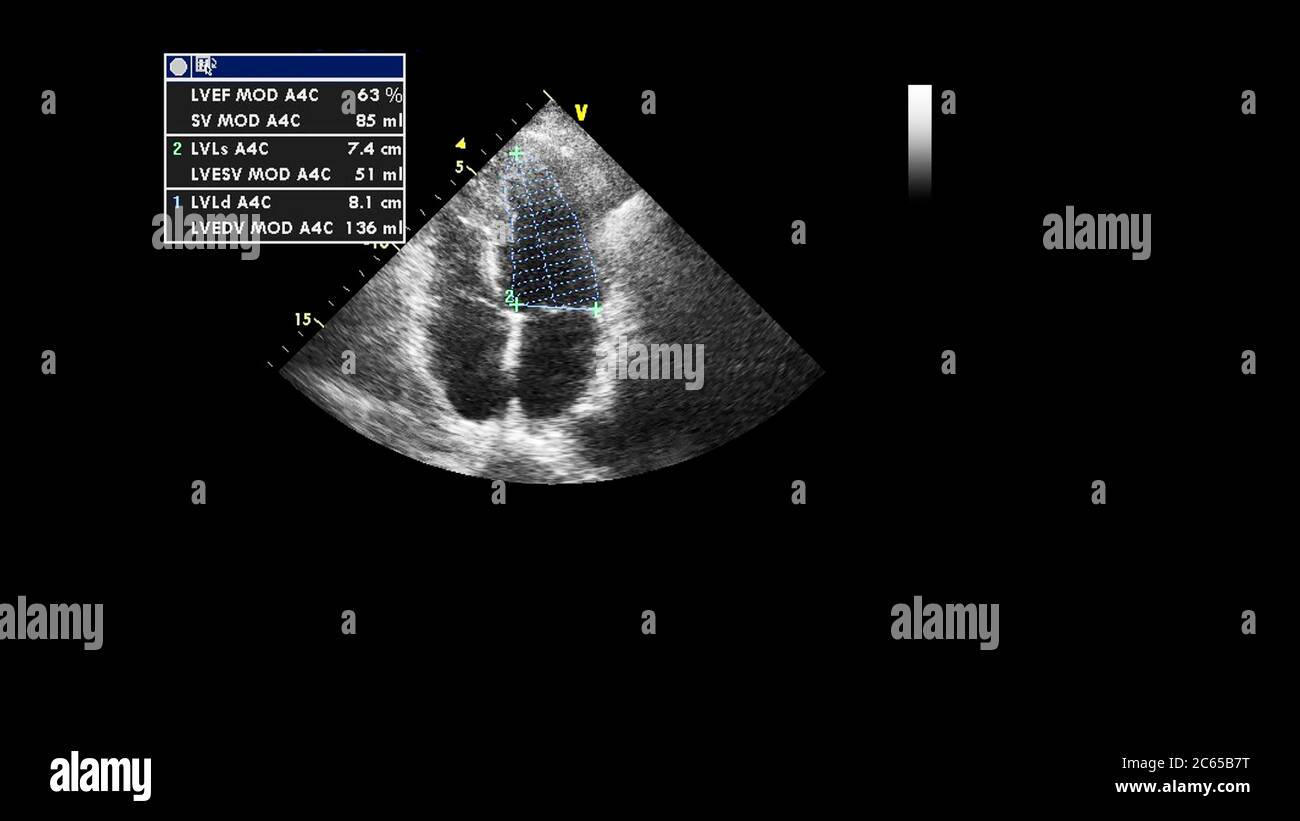Image of the heart in gray-scale mode during transesophageal ultrasound ...