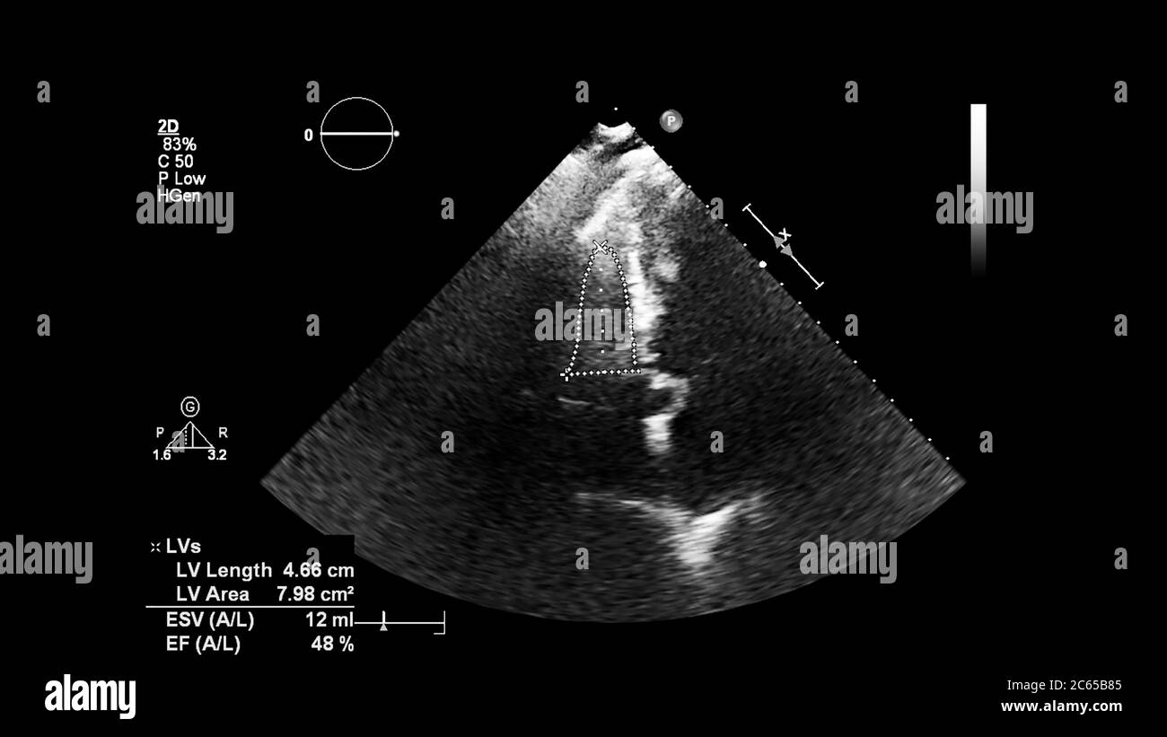 Image of the heart in gray-scale mode during transesophageal ultrasound ...