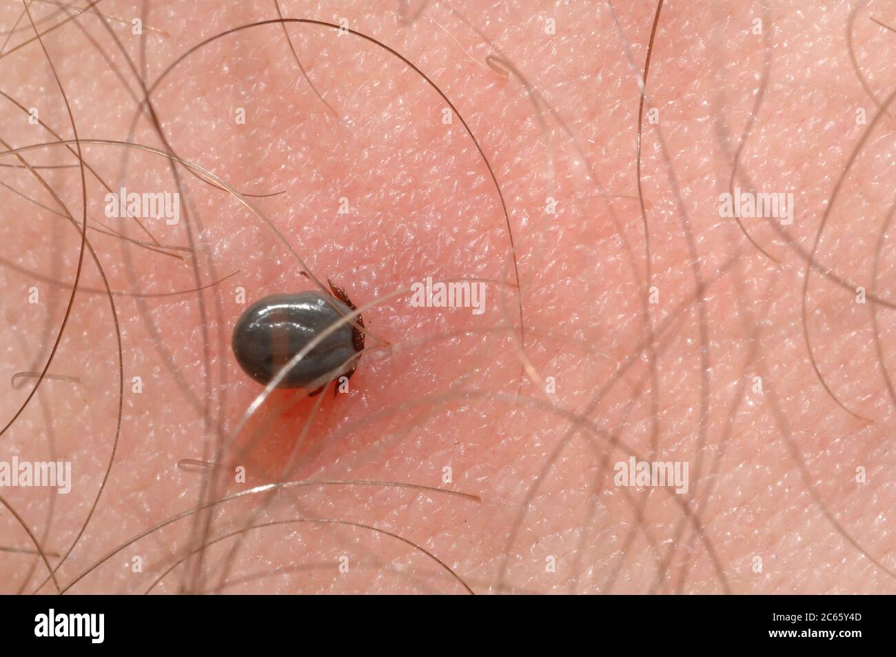 Tick pincers hi-res stock photography and images - Alamy
