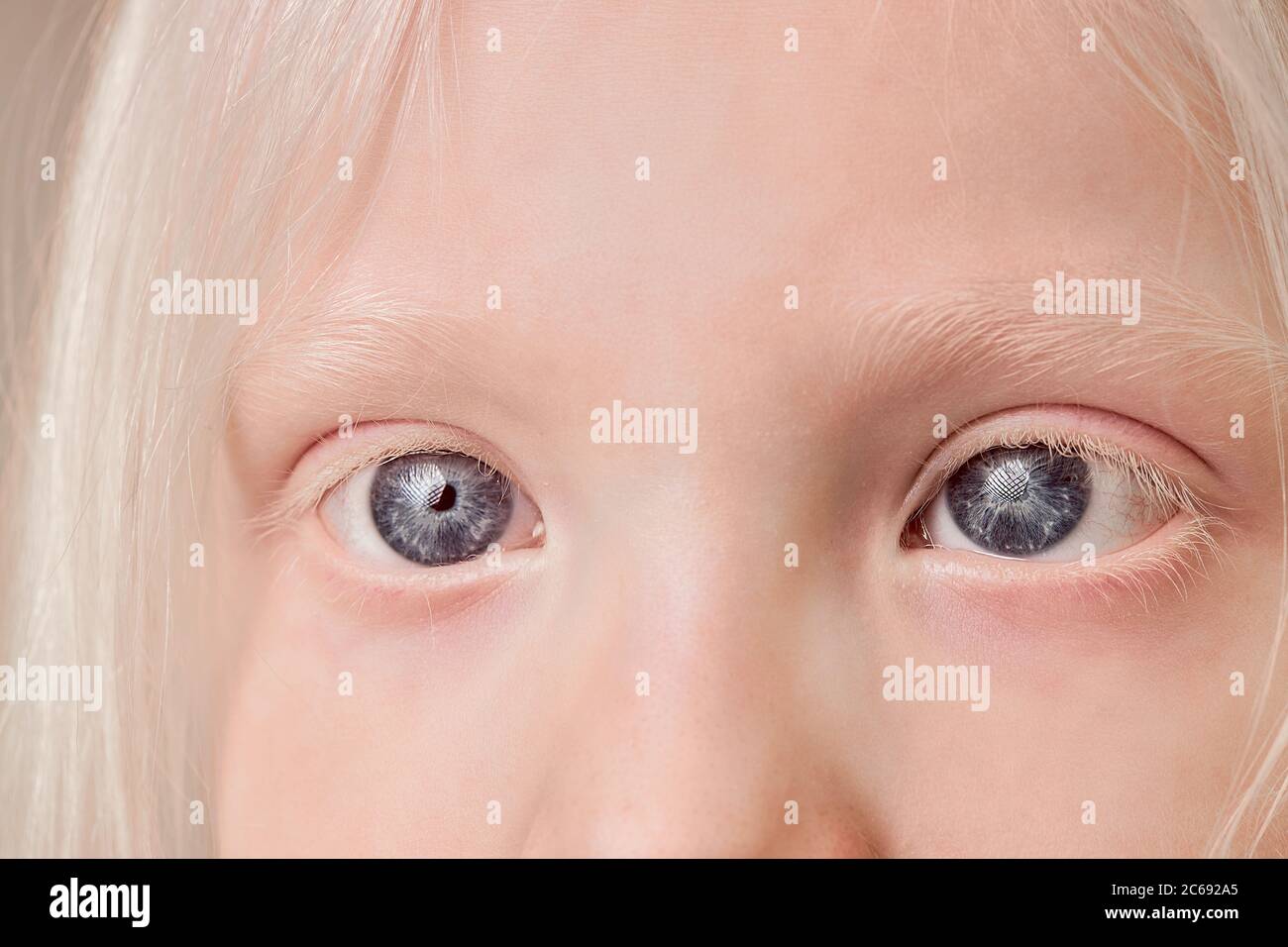 Natural Violet Eye Color Albino