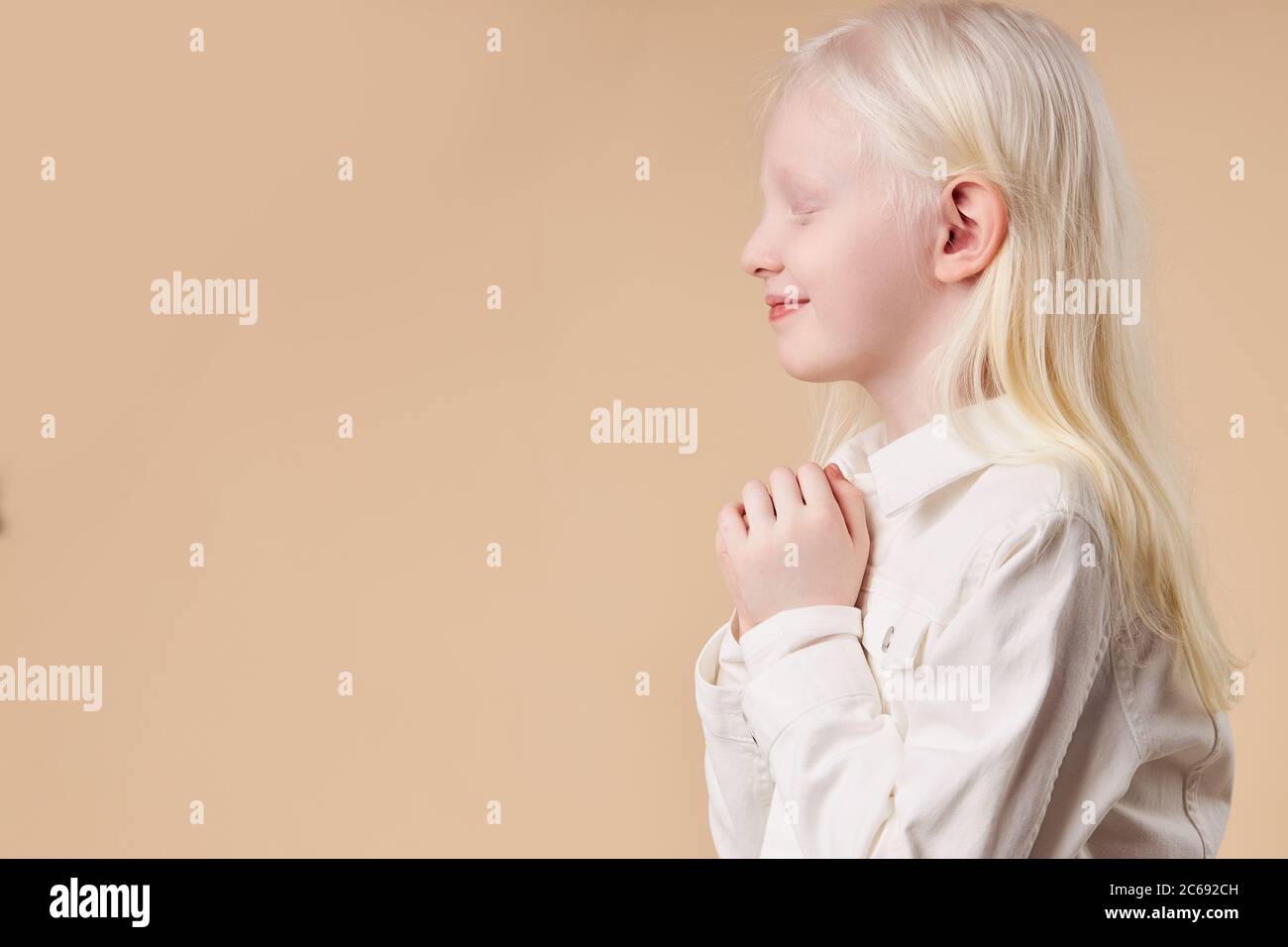 Albino. Cute caucasian little girl with albinism syndrome, natural ...