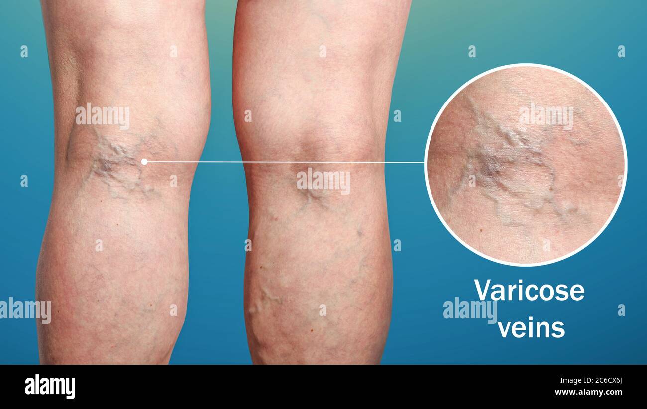 The old age and sick of a woman. Varicose veins on a legs of woman. The ...