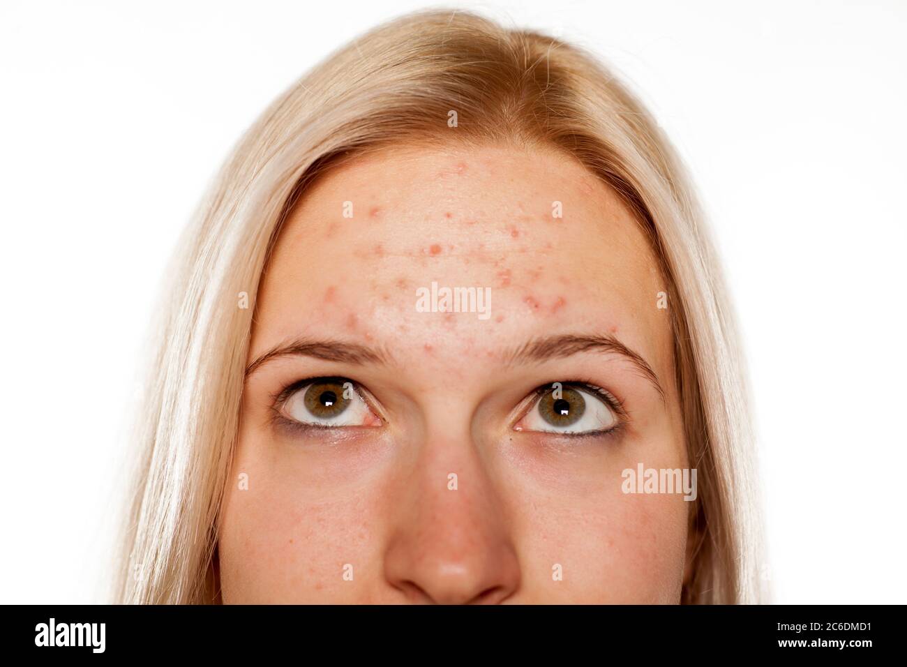 Young blond with pimples on her forehead Stock Photo - Alamy