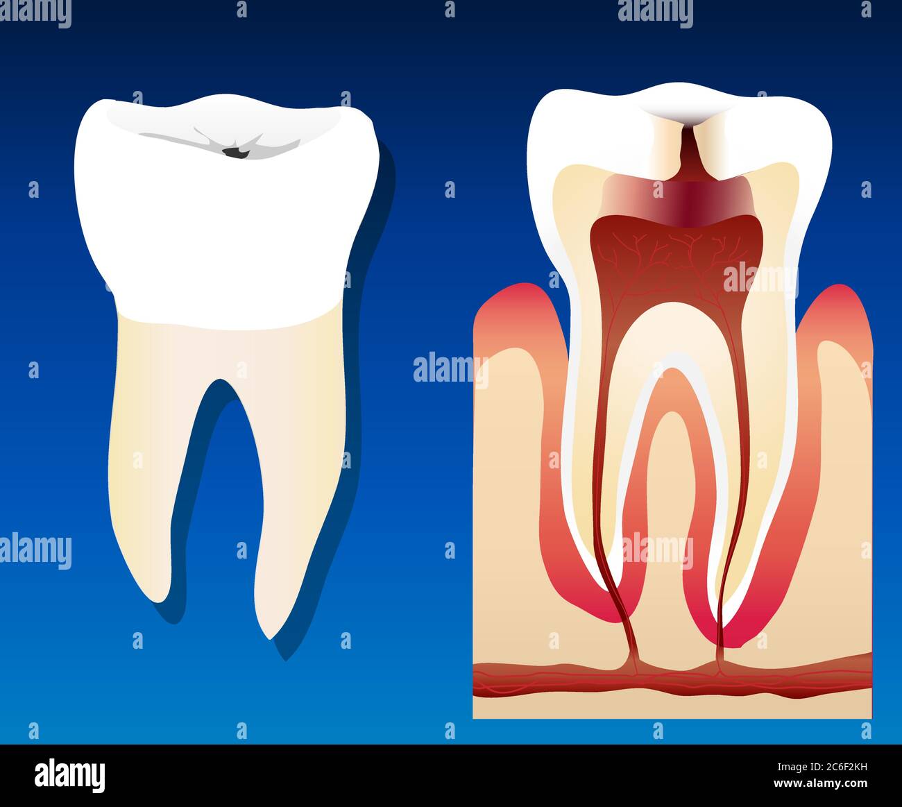 A vector llustration showing an unhealthy tooth with a cross section ...