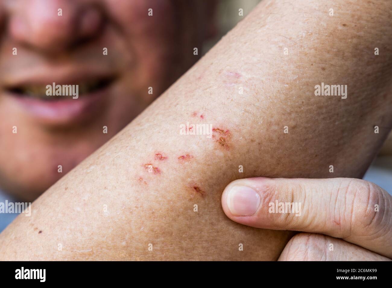 Person embracing painful wound on skin a result of scratching due to ...