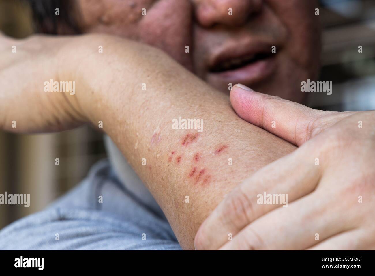 Person embracing painful wound on skin a result of scratching due to ...