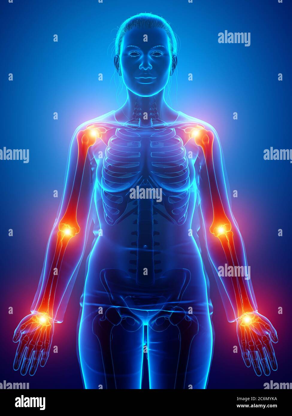3d Illustration of Female arm joint pain Stock Photo - Alamy