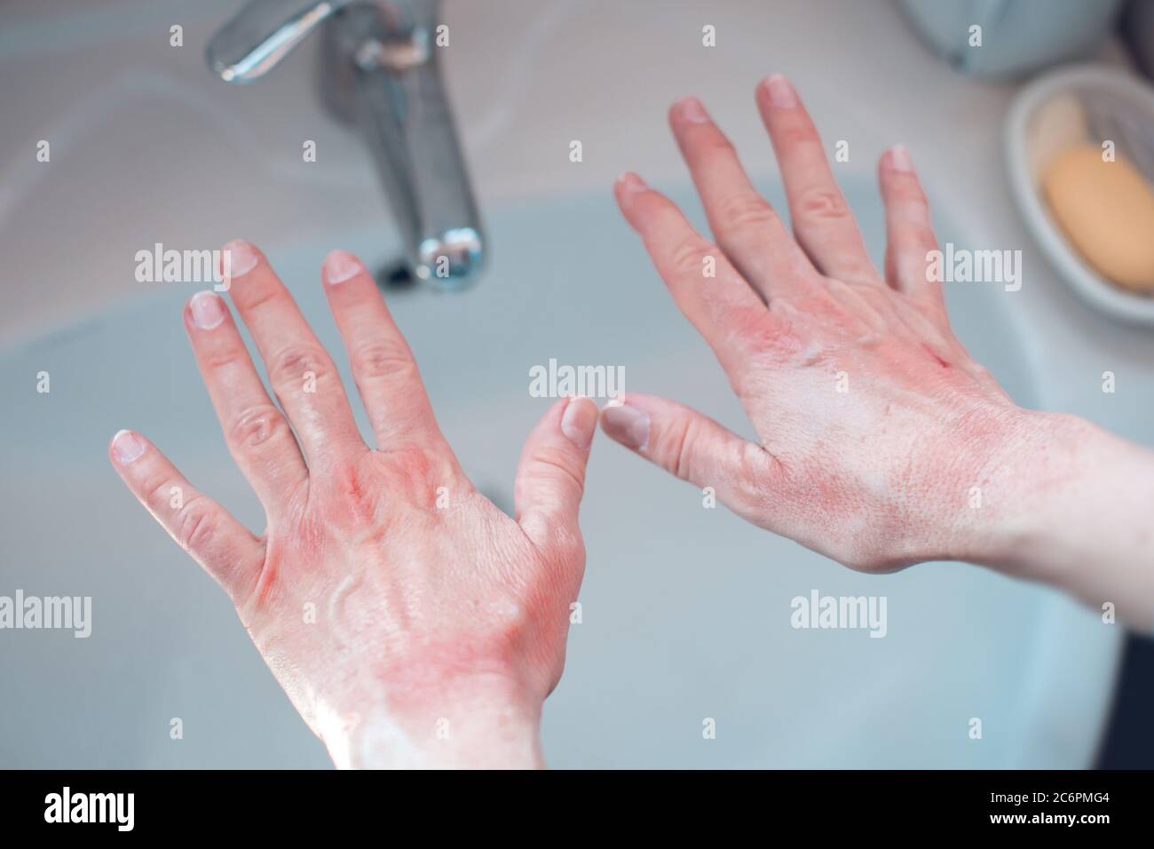 damaged hands from extensive washing Stock Photo - Alamy