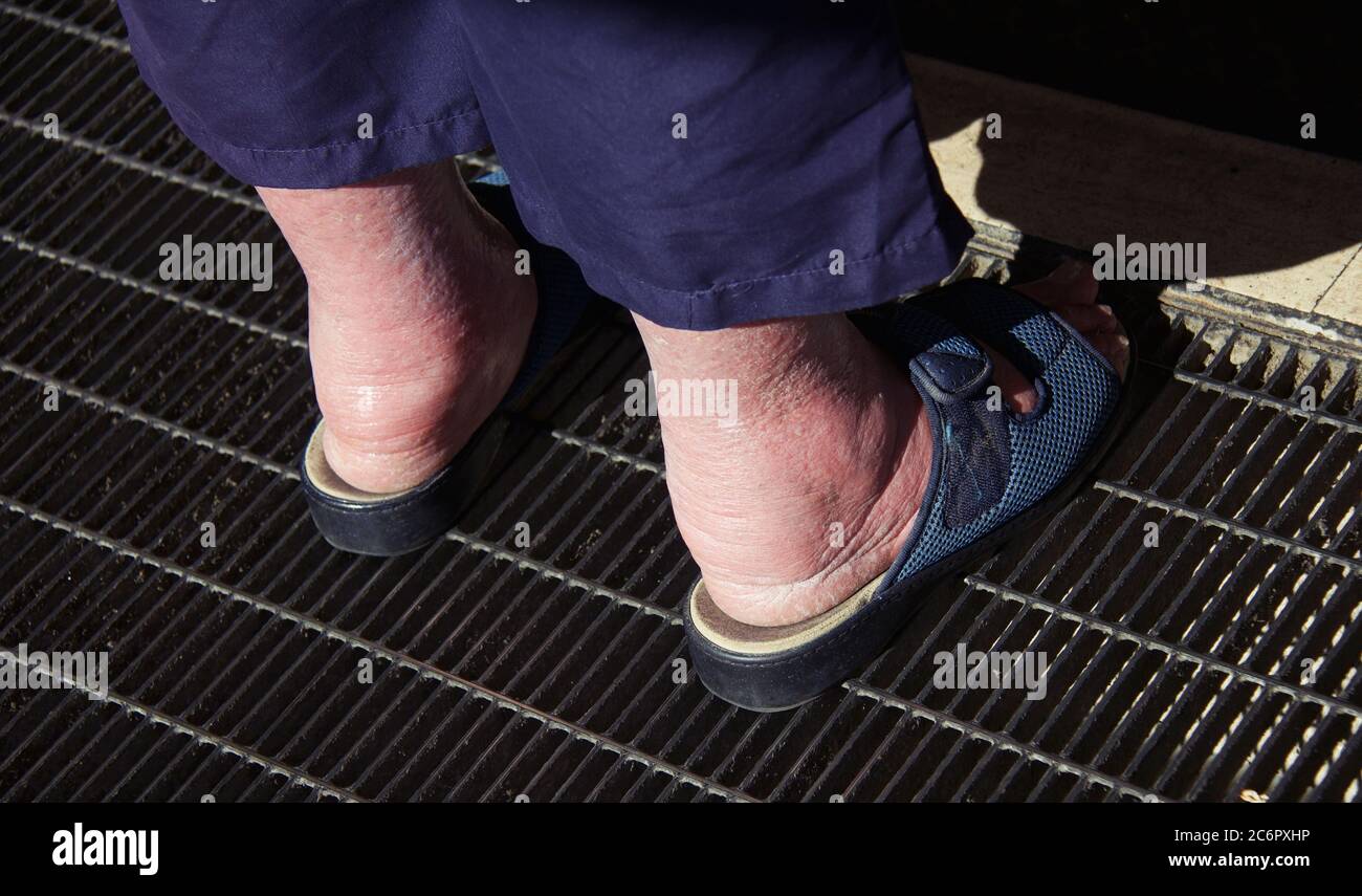 old senior feet, problem of overweight and obesity Stock Photo - Alamy
