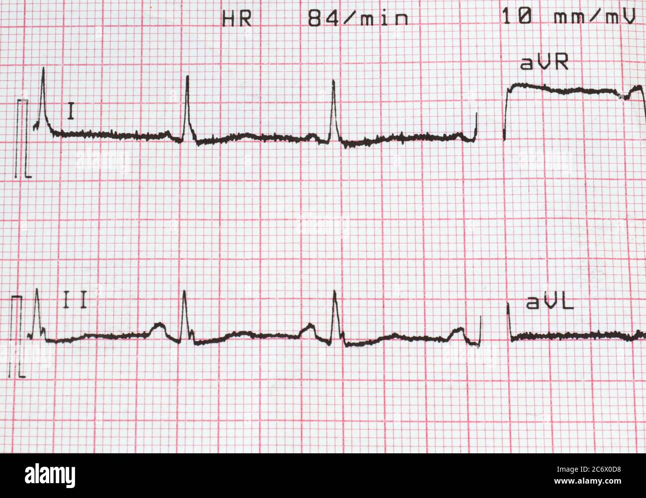 Electrocardiogram test that shows electrical activity of the heart ...