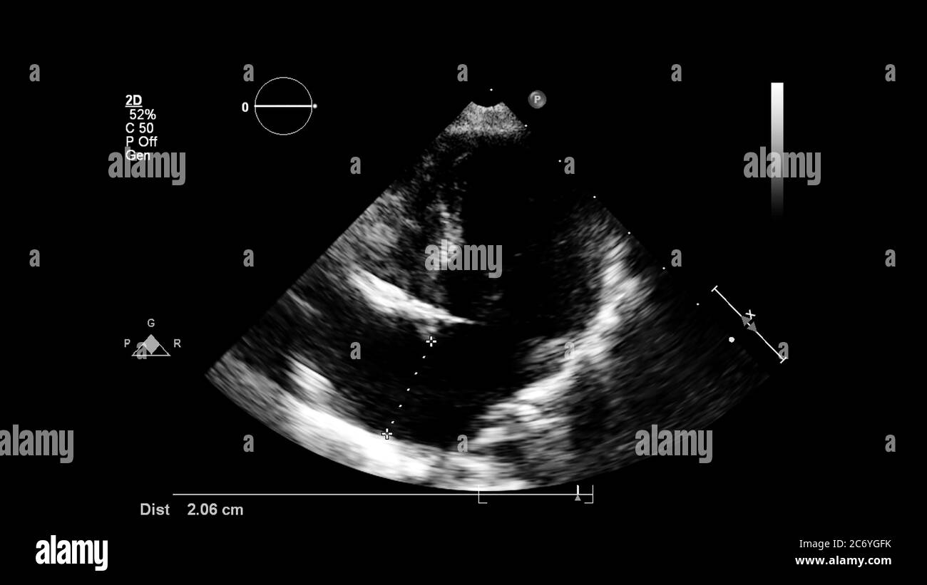 Image of the heart in gray-scale mode during transesophageal ultrasound ...