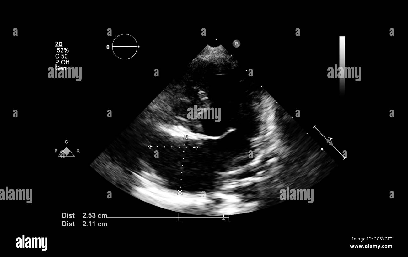 Image of the heart in gray-scale mode during transesophageal ultrasound ...