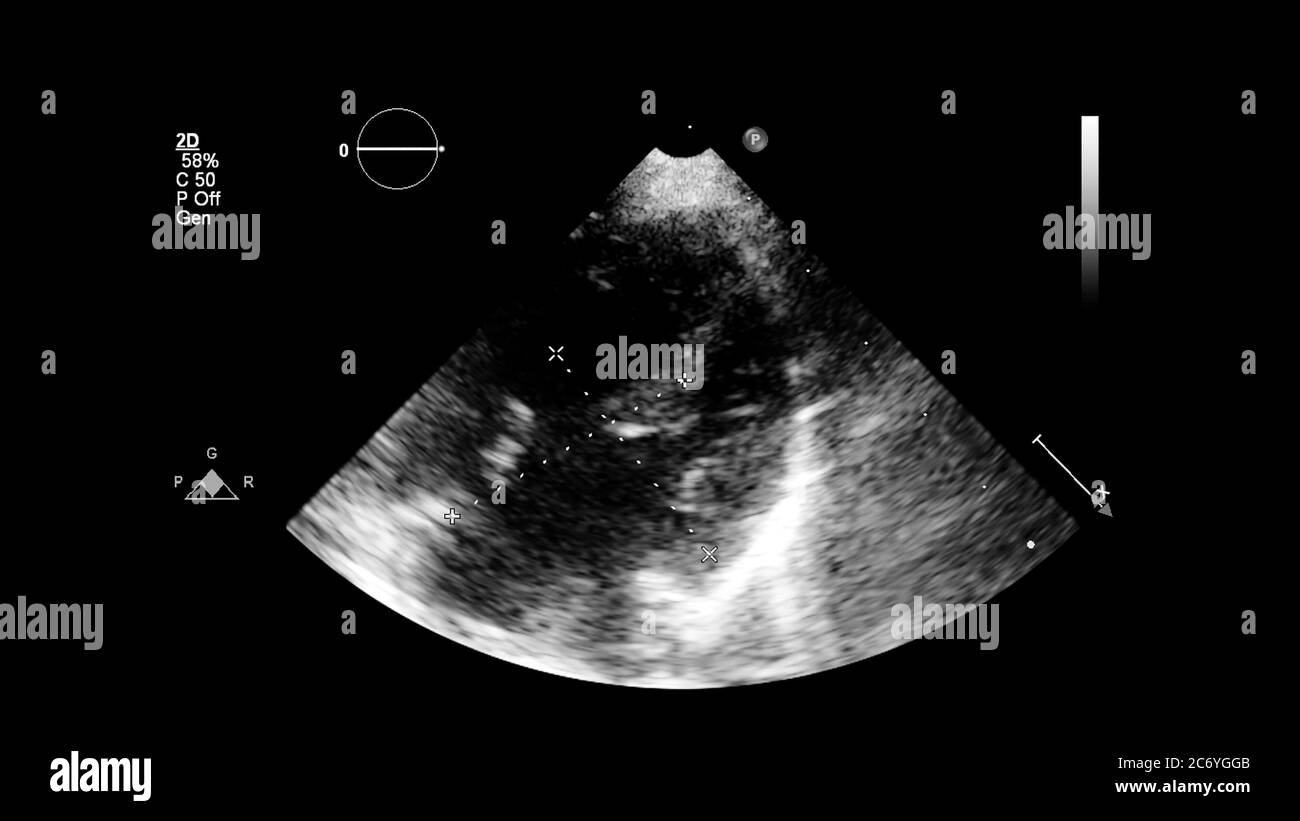 Image of the heart in gray-scale mode during transesophageal ultrasound ...