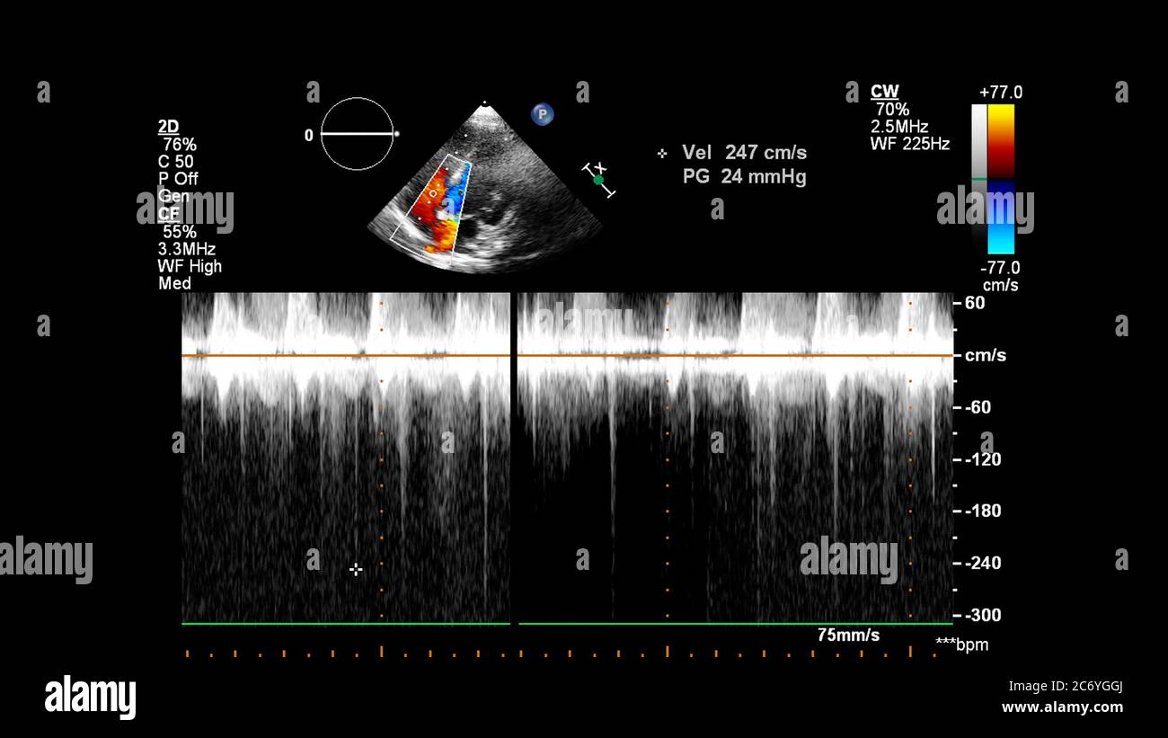 Image of the heart during transesophageal ultrasound with Doppler mode ...