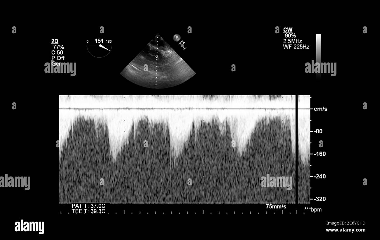 Image of the heart in gray-scale mode during transesophageal ultrasound ...
