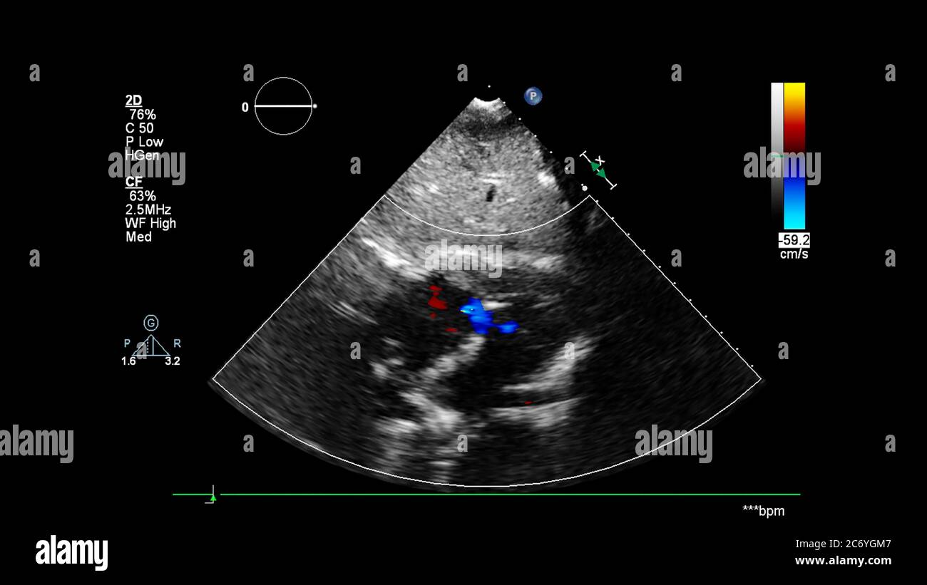 Image of the heart during transesophageal ultrasound with Doppler mode ...