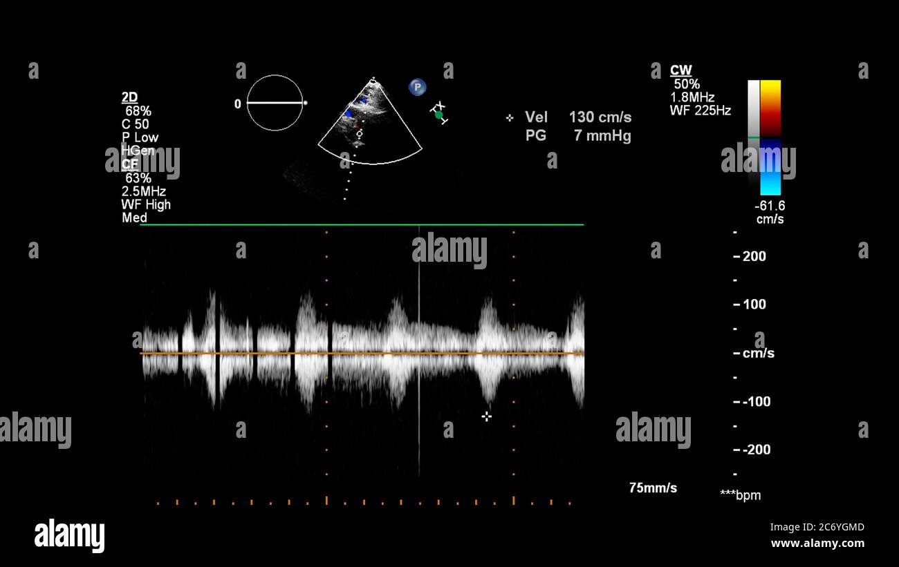 Image of the heart during transesophageal ultrasound with Doppler mode ...
