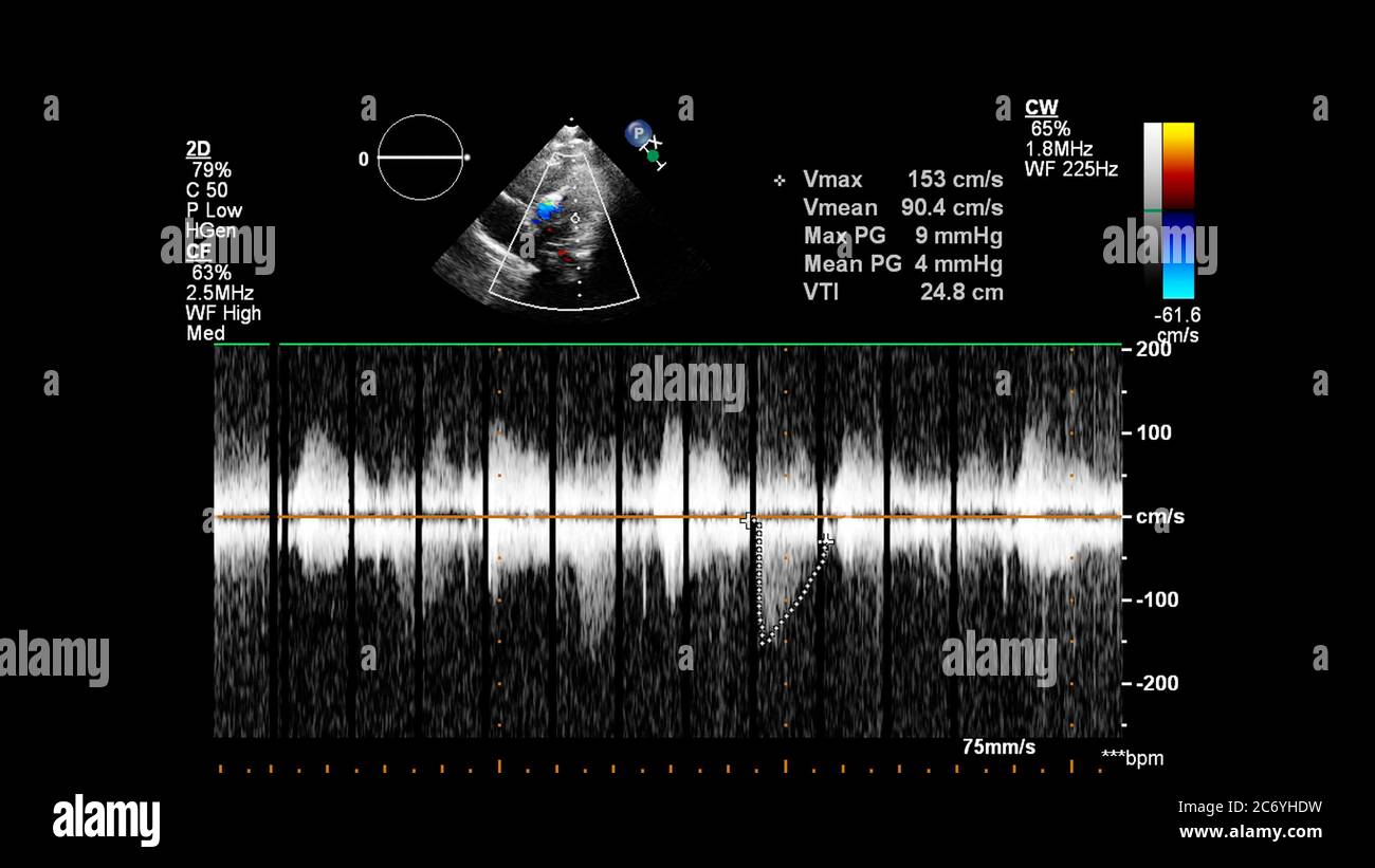 Image of the heart during transesophageal ultrasound with Doppler mode ...