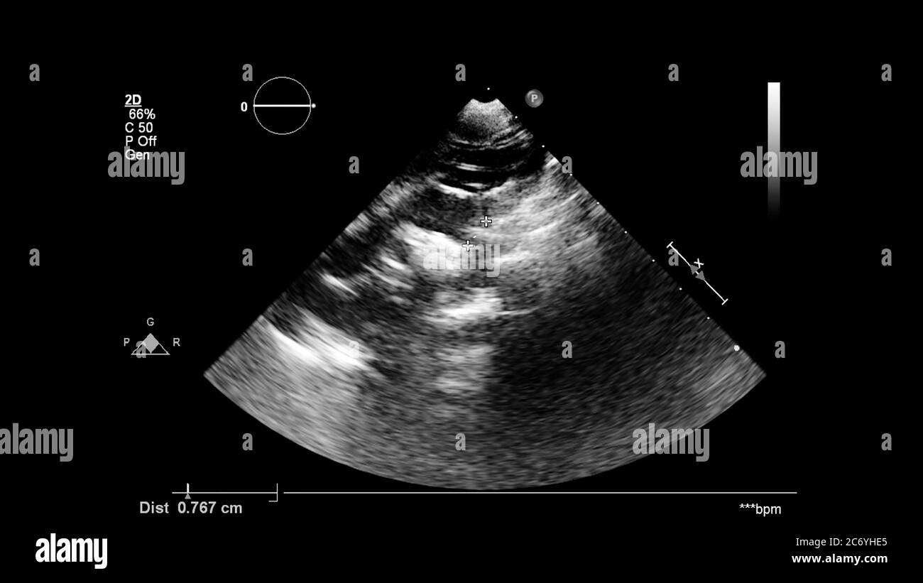 Image of the heart in gray-scale mode during transesophageal ultrasound ...
