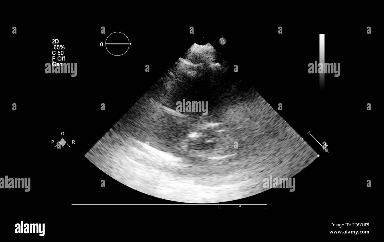 Image of the heart in gray-scale mode during transesophageal ultrasound ...