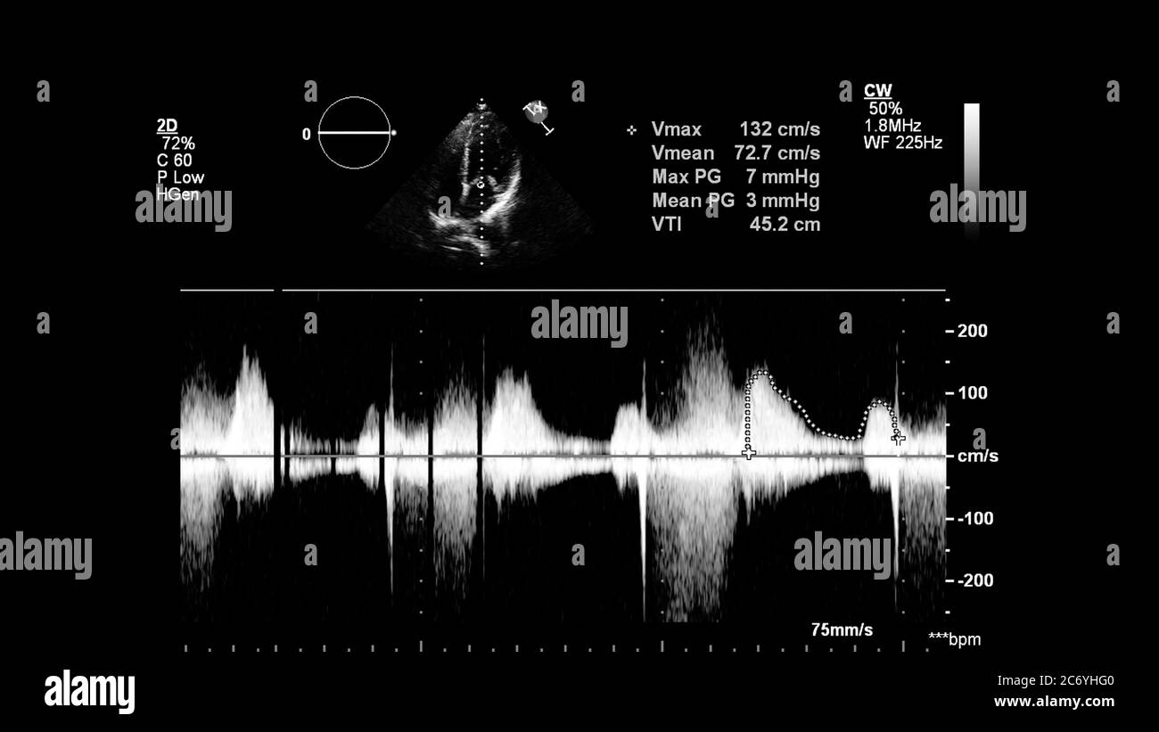 Image of the heart in gray-scale mode during transesophageal ultrasound ...