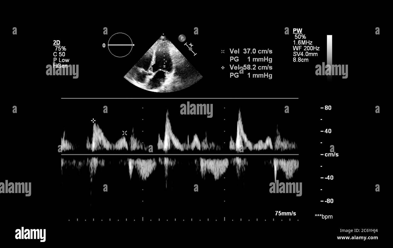 Image of the heart in gray-scale mode during transesophageal ultrasound ...