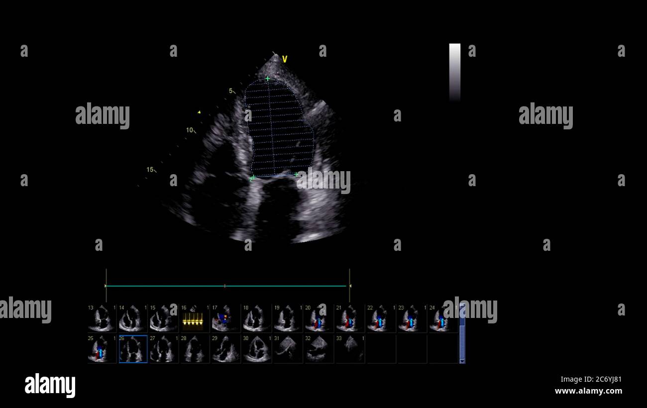 Image of the heart in gray-scale mode during transesophageal ultrasound ...