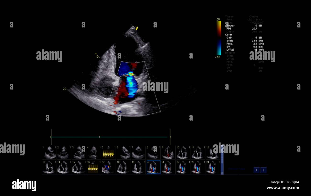 Image of the heart during transesophageal ultrasound with Doppler mode ...