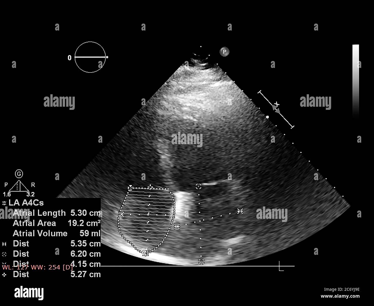 Image of the heart in gray-scale mode during transesophageal ultrasound ...