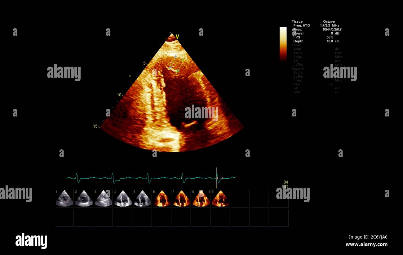 Image of the heart in gray-scale mode during transesophageal ultrasound ...