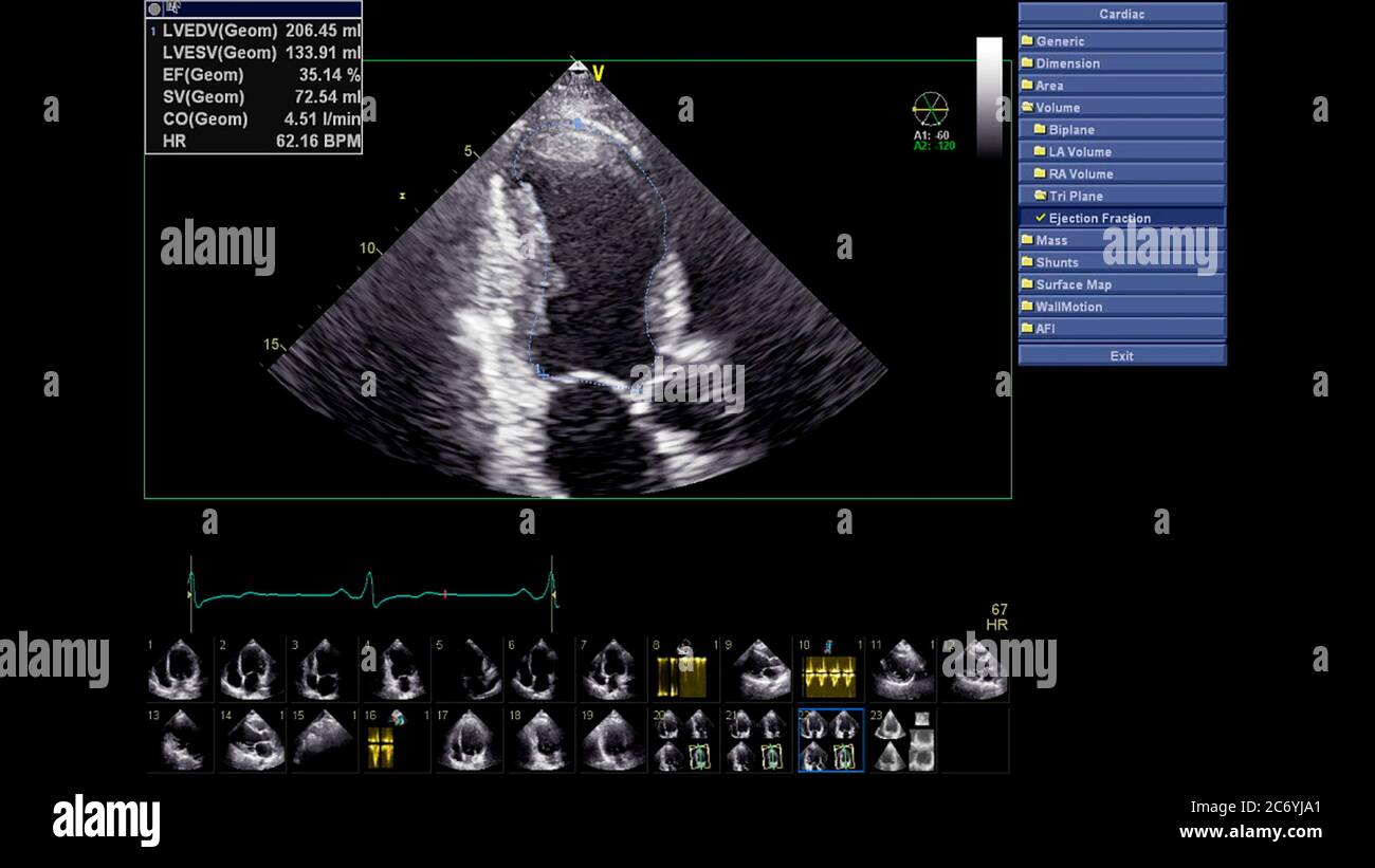 Image of the heart in gray-scale mode during transesophageal ultrasound ...
