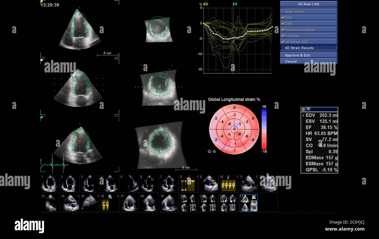 Image of the heart in gray-scale mode during transesophageal ultrasound ...