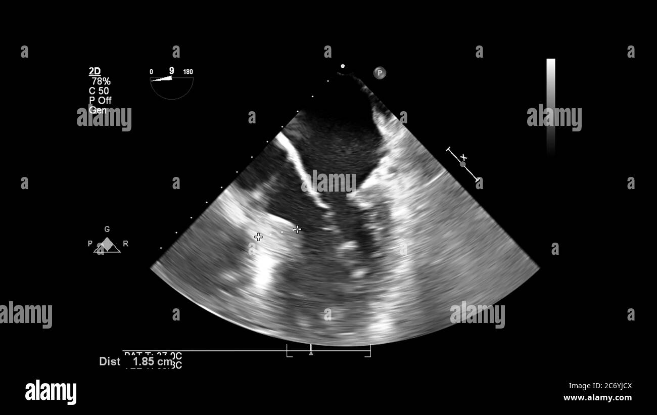 Image of the heart in gray-scale mode during transesophageal ultrasound ...