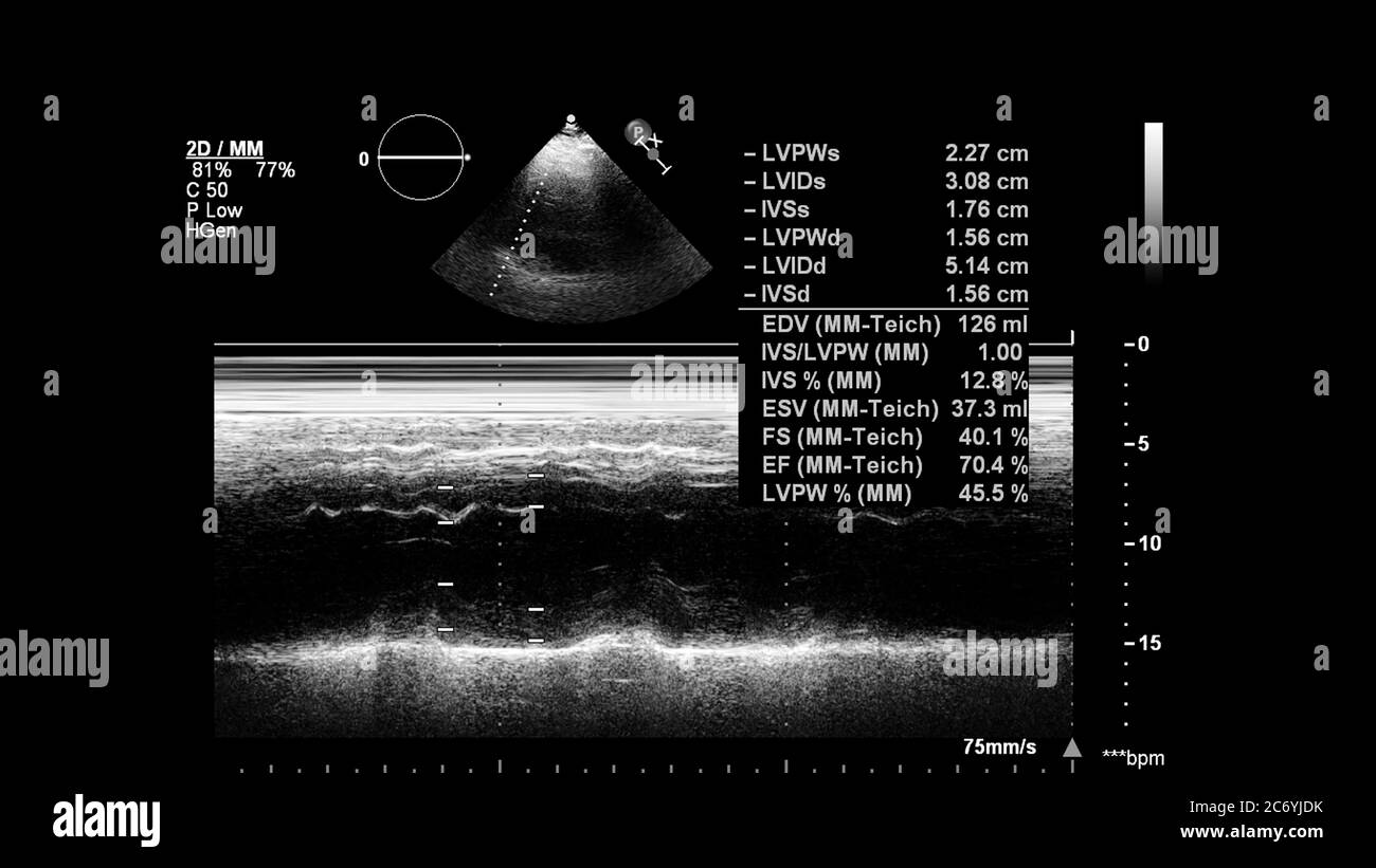 Image of the heart in gray-scale mode during transesophageal ultrasound ...