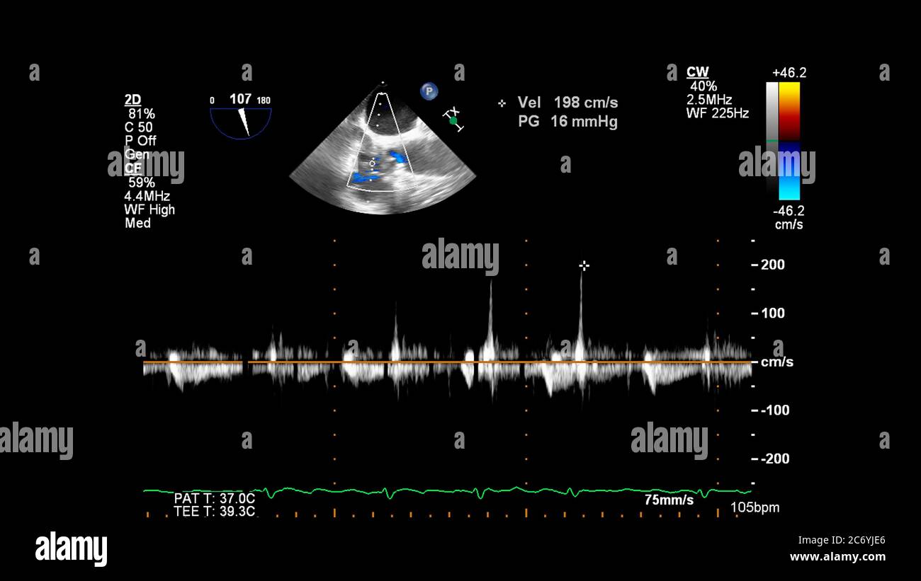 Image of the heart during transesophageal ultrasound with Doppler mode ...