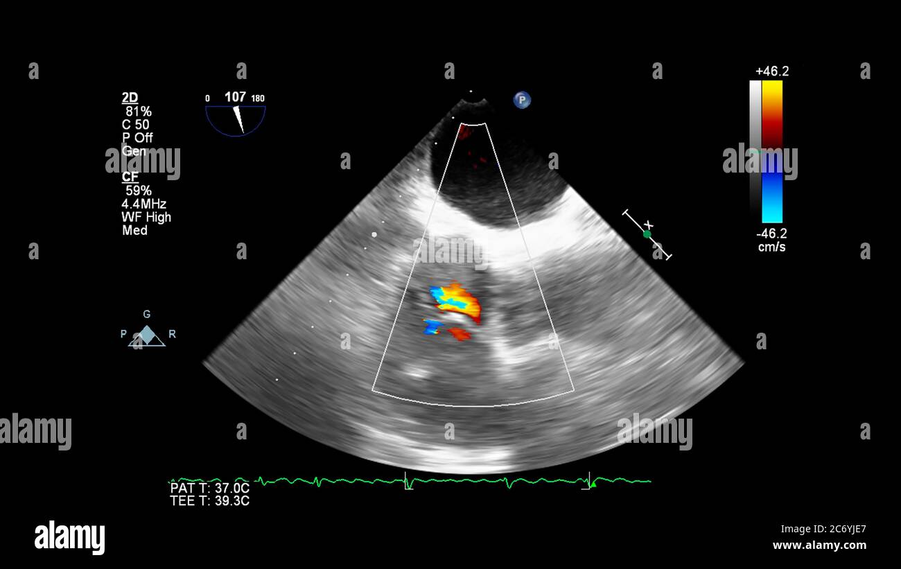 Image of the heart during transesophageal ultrasound with Doppler mode ...