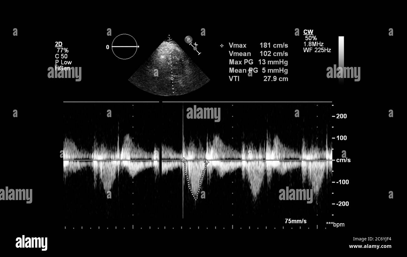 Image of the heart in gray-scale mode during transesophageal ultrasound ...